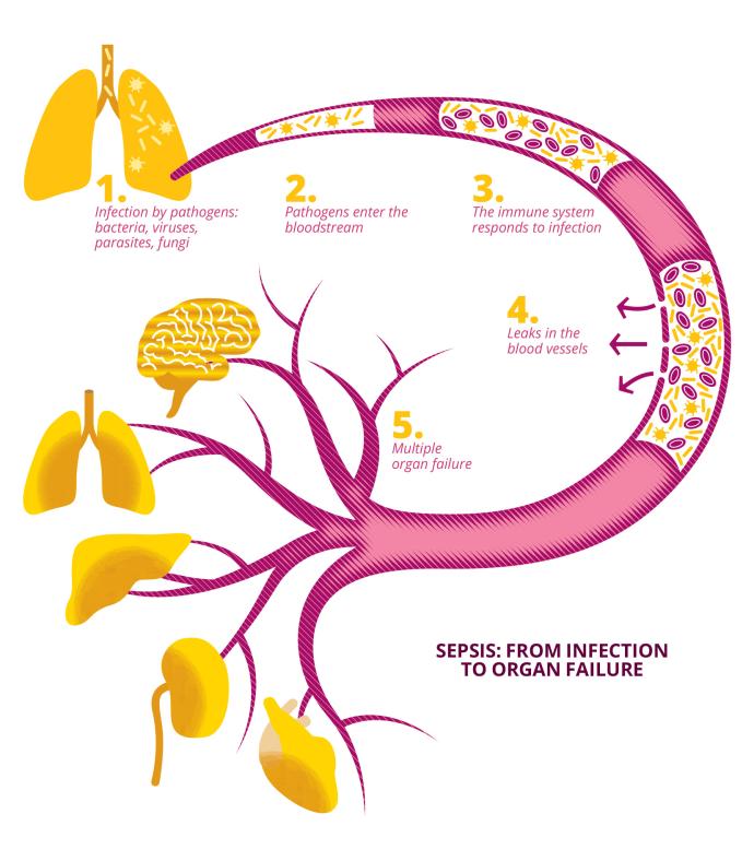 Sepsis: a long-term battle, new issues and goals | Université Paris-Saclay